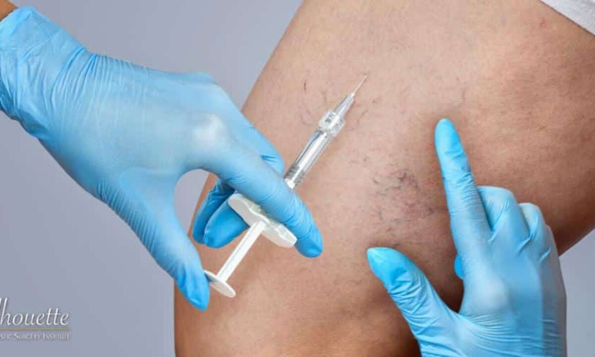 Collapsed Vein Arm